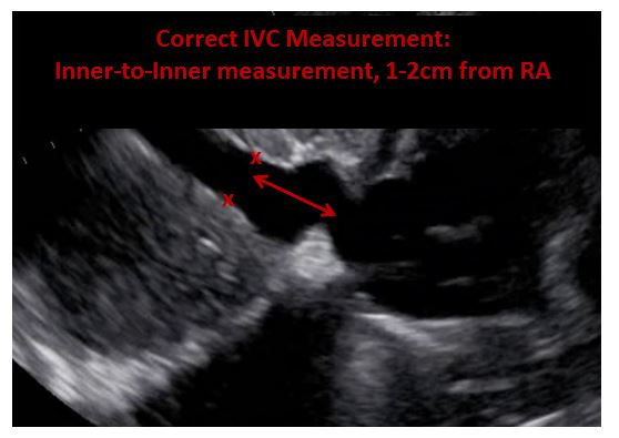 Pulmonary Hypertension Case Study Presentation Cardioserv