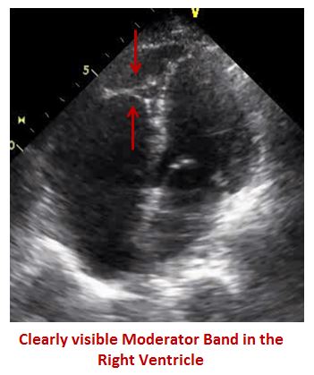 Pulmonary Hypertension Case Study Presentation Cardioserv