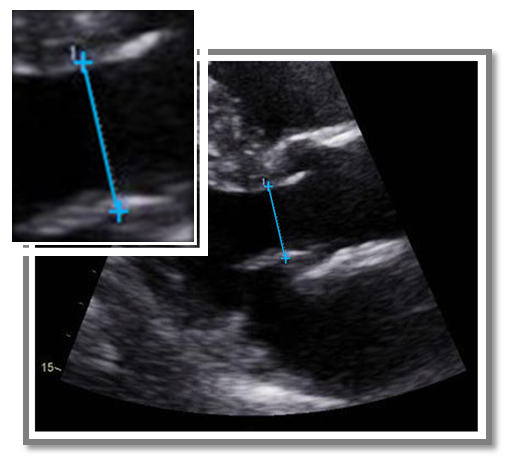 How to Master Aortic Measurements With These 5 Techniques Cardioserv