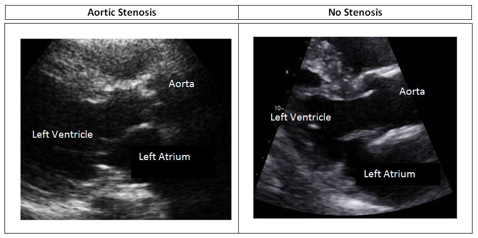 How to Master Aortic Measurements With These 5 Techniques Cardioserv