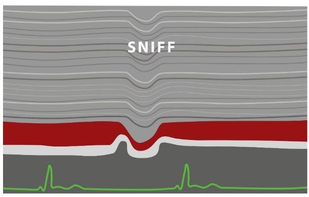 8 Things to Know About Estimation of RAP via Echocardiography Cardioserv