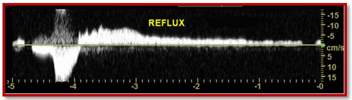 Tips for Obtaining Accurate Venous Reflux Cardioserv
