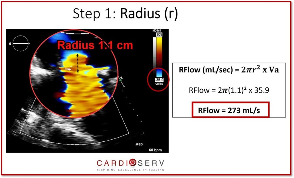 A Complete Guide to Performing MR PISA! Cardioserv