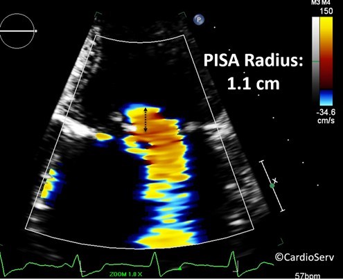 Mitral Regurgitation Case Study Demonstration! Cardioserv