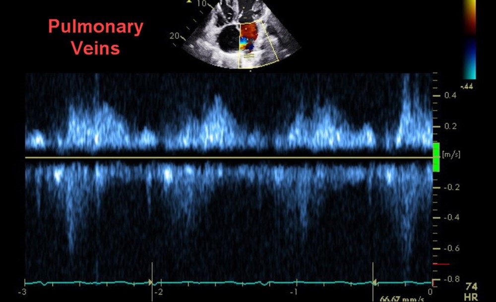 Mitral Regurgitation Case Study Demonstration! Cardioserv