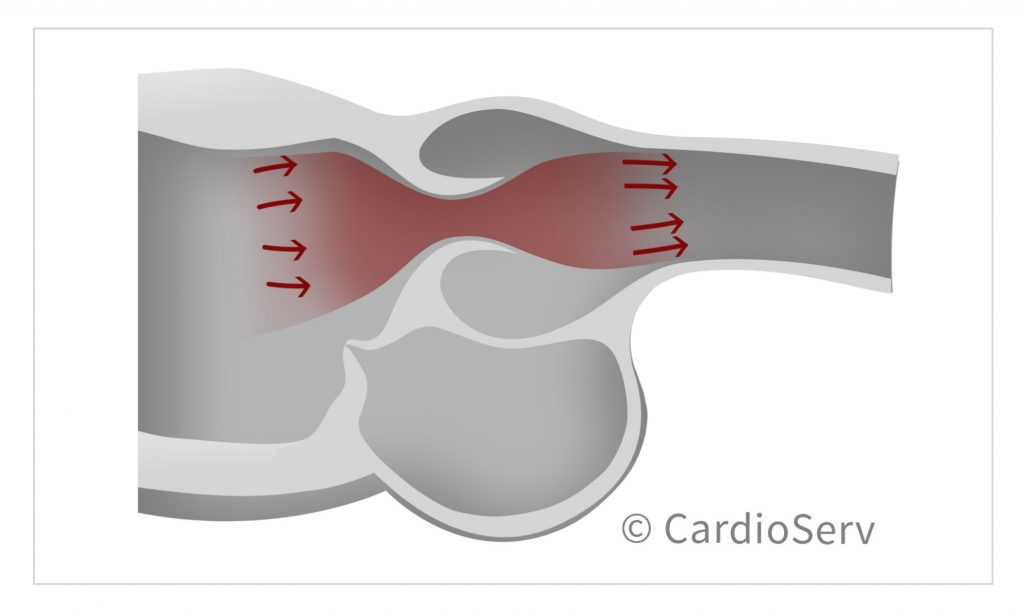 Aortic Stenosis: Breaking Down the Continuity Equation Cardioserv