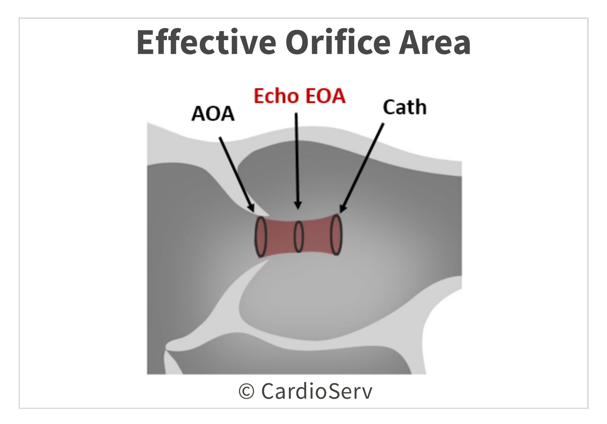 Aortic Stenosis: Breaking Down the Continuity Equation Cardioserv