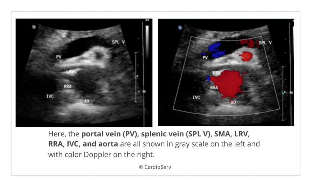 Abdominal Ultrasound for Echocardiographers: Aorta and IVC Cardioserv
