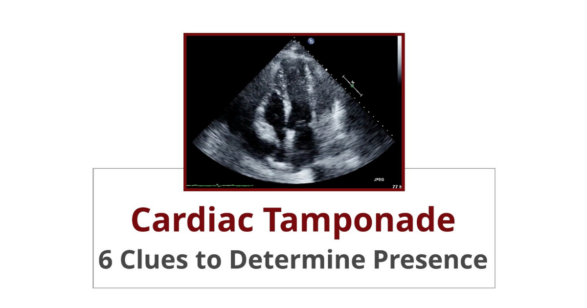 6 Clues to Determining Presence of Cardiac Tamponade Cardioserv