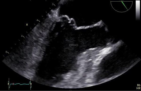 What the Clip! MitraClip Echo Symposium Highlights Cardioserv