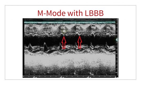 Echocardiography in the Presence of Left Bundle Branch Block Cardioserv