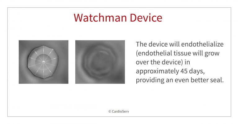 What is the Watchman Device and How Does it Work? Cardioserv